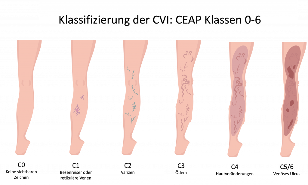 Venensystem und CVI - Vascular Academy | powered by SOT