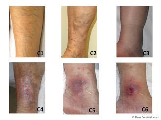 Venous System and CVI - Vascular Academy | powered by SOT