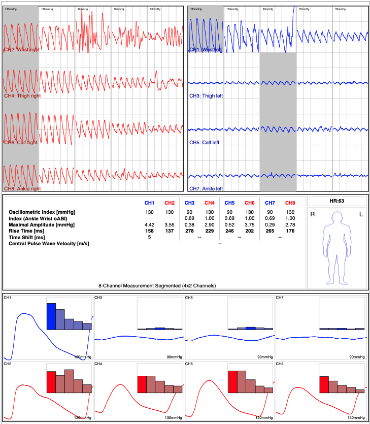 PVR – Pulse Volume Recording - Vascular Academy | powered by SOT