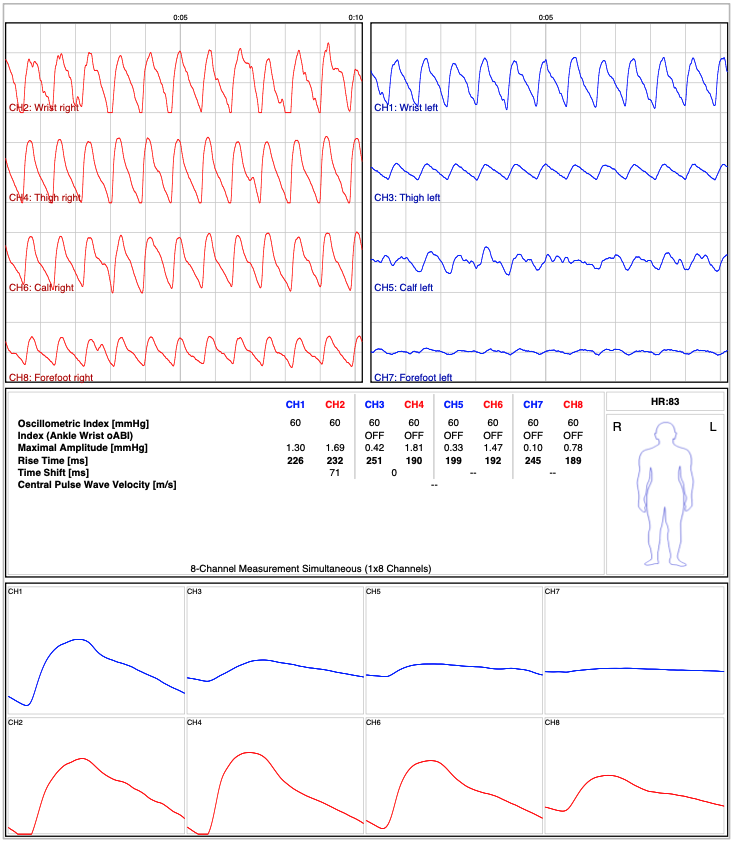 PVR – Pulse Volume Recording - Vascular Academy | powered by SOT