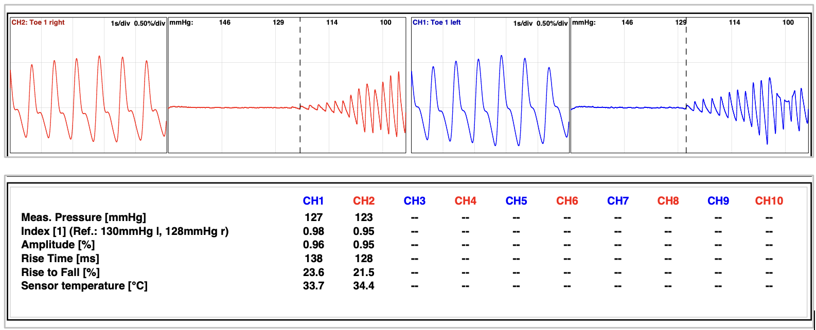 OAP – Optical Arterial Pressure - Vascular Academy | powered by SOT