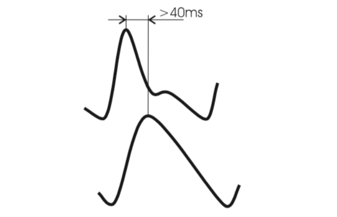 Pulse Wave Parameters - Vascular Academy | powered by SOT