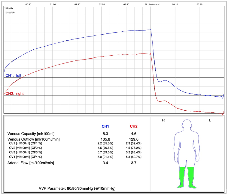 VOP – Venous Occlusion Plethysmography - Vascular Academy | powered by SOT